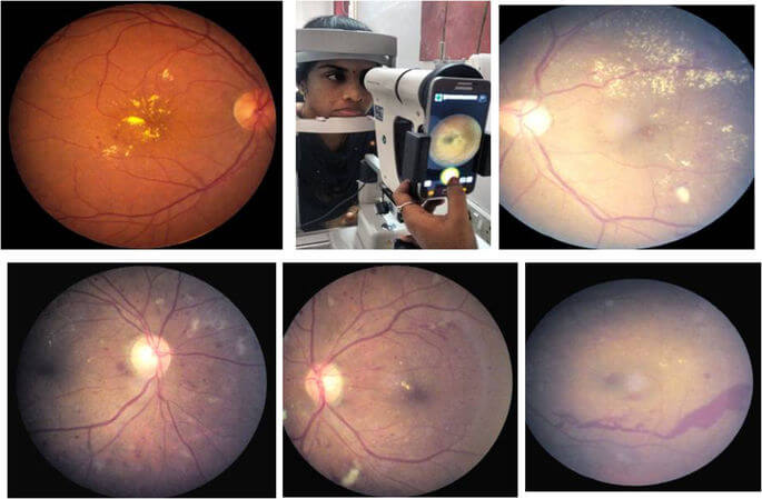 Eyenuk Inc.’s AI-based diabetic retinopathy screening software EyeArt ...