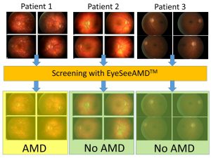 Products Under Development - Eyenuk, Inc. ~ Artificial Intelligence Eye ...
