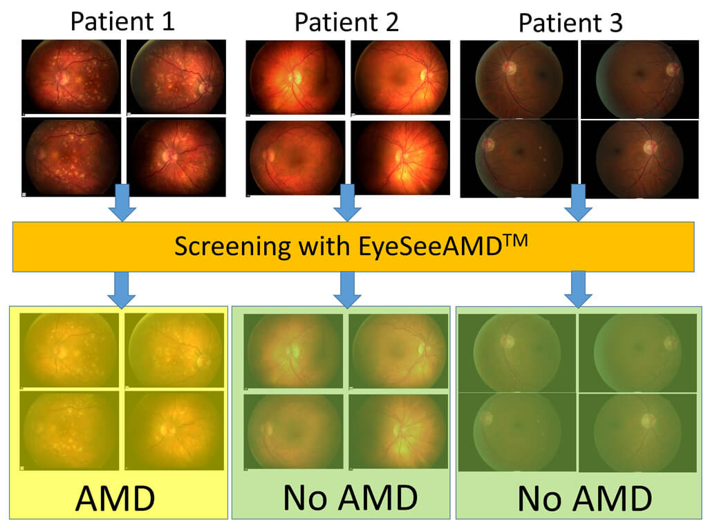 Products Under Development - Eyenuk, Inc. ~ Artificial Intelligence Eye ...