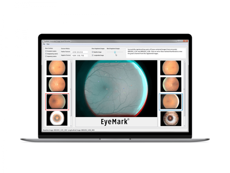 Products Under Development - Eyenuk, Inc. ~ Artificial Intelligence Eye Screening